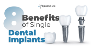 8 Benefits of Single Dental Implants - Implants 4 Life