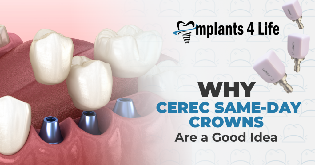 Why CEREC Same-Day Crowns Are a Good Idea