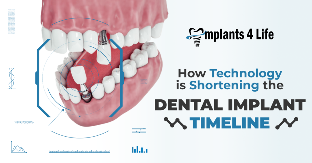 How Technology Is Shortening the Dental Implant Timeline - Implants 4 Life