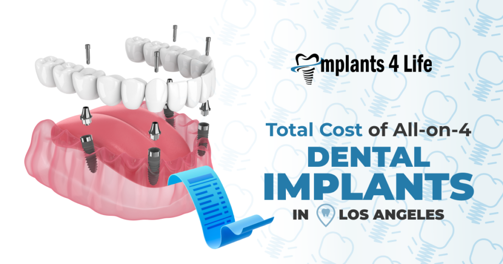 Total Cost of All-on-4 Dental Implants in Los Angeles | Implants4Life